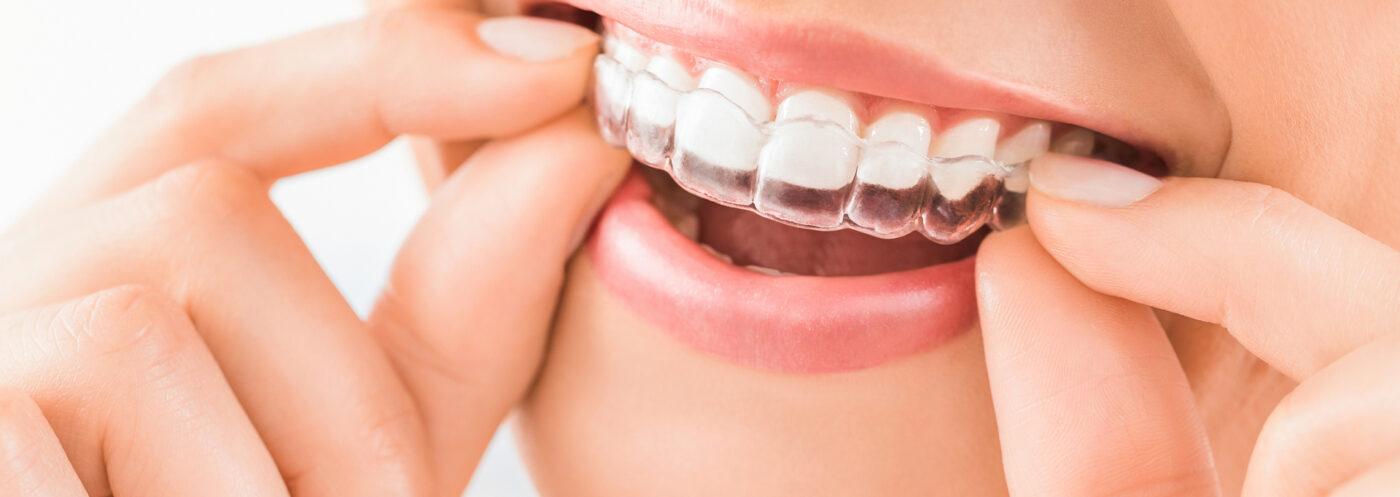 SPARK CLEAR ALIGNERS - Dr. Piela